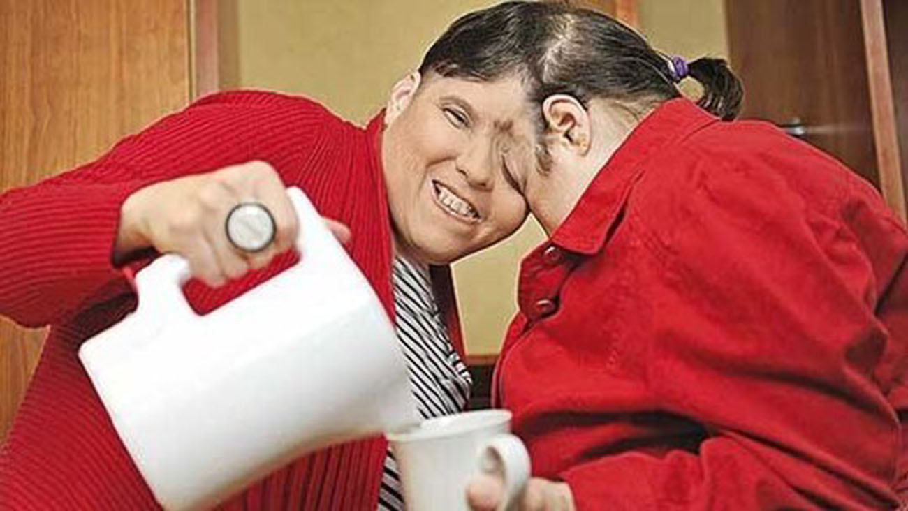 سختی خواهر و برادر دوقلوهای به هم چسبیده از زیباترین دوقلوهای به هم